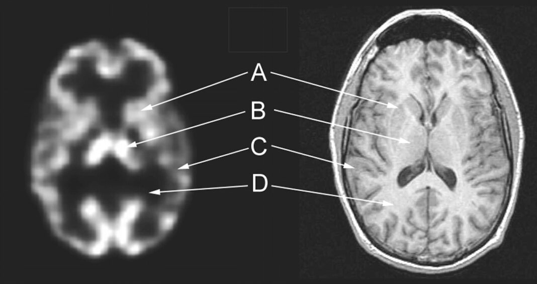 Brain SPECT Imaging Benefits and Applications - Opptrends 2025